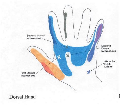 Pressure Point Hand