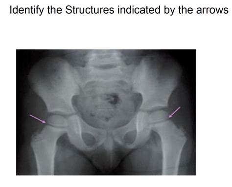 Proximal Femur Diagram Quizlet