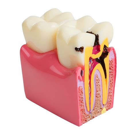 Buy Pevor New Dental Teeth Model Dental Caries Tooth Model Patient