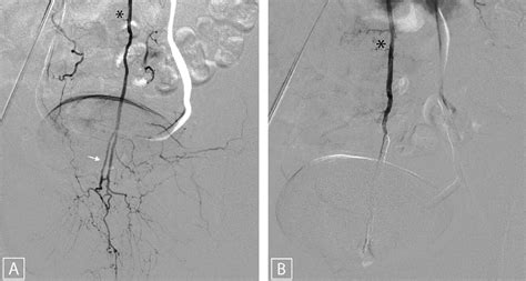 Digital Subtraction Angiography DSA In Posteroanterior Projection Download Scientific