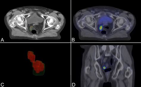Frontiers Prostate Specific Membrane Antigen Based Imaging For Stereotactic Irradiation Of Low