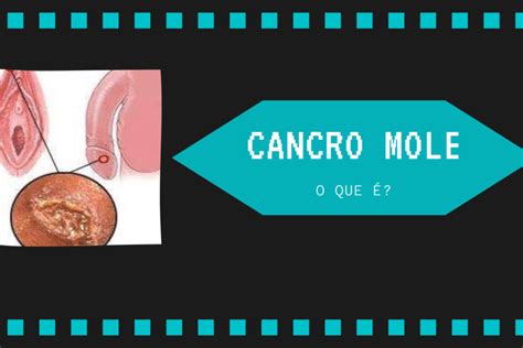 Cancro Mole Dr Fernando Leone Urologista Bh Urologista Bh