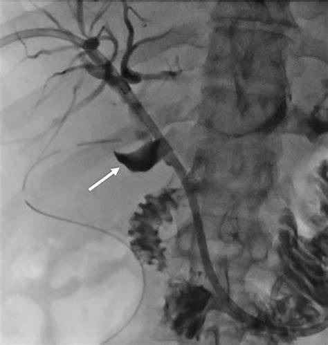 The Cholangiographic Control Performed 3 Weeks After Surgery