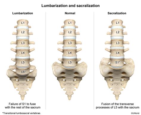 Lumbarization And Sacralization — Cote Illustration