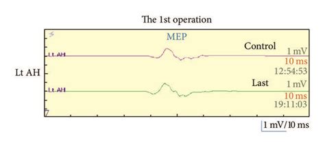 Intraoperative Spinal Cord Monitoring Although There Was No Worsening Download Scientific