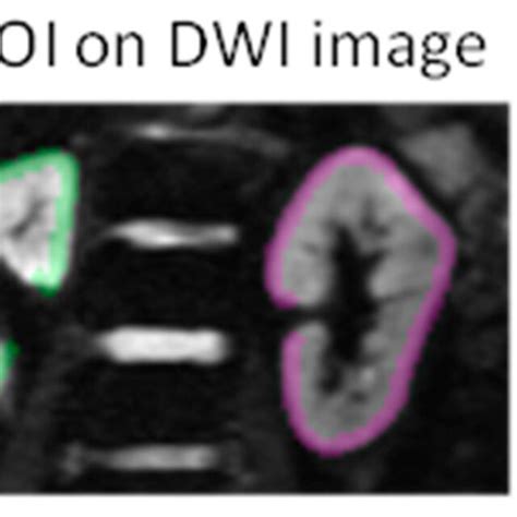 A Representative Diffusion Weighted Image B Manually Defined Download Scientific Diagram
