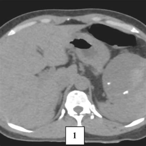 Plain Axial Ct Of The Cyst Showing Areas Of Relative Hyperdensity And