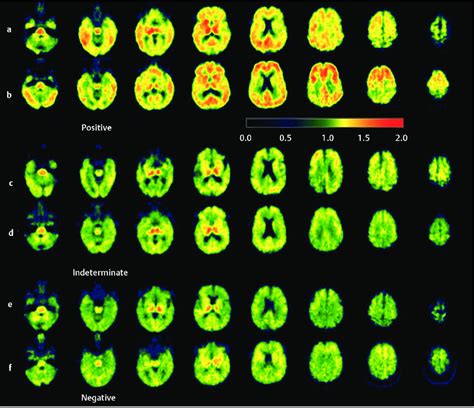 Amyloid Image With C Pittsburgh Compound B PET Scan A B Download Scientific Diagram