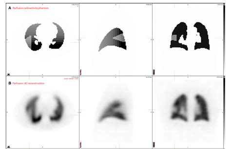 Figure 3 From Normal Dual Isotope V Q Spect Model For Monte Carlo