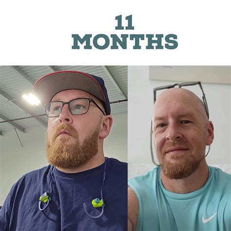1 Year Cico Before And After Rcico