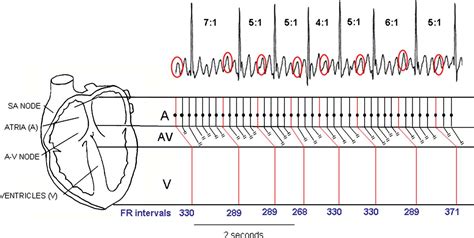 Figure 1 From Ladder Diagrams For Atrial Flutter And Atrial Fibrillation Semantic Scholar