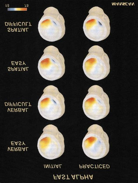 High Resolution Eeg Topographic Maps Showing The Deblurred Topography