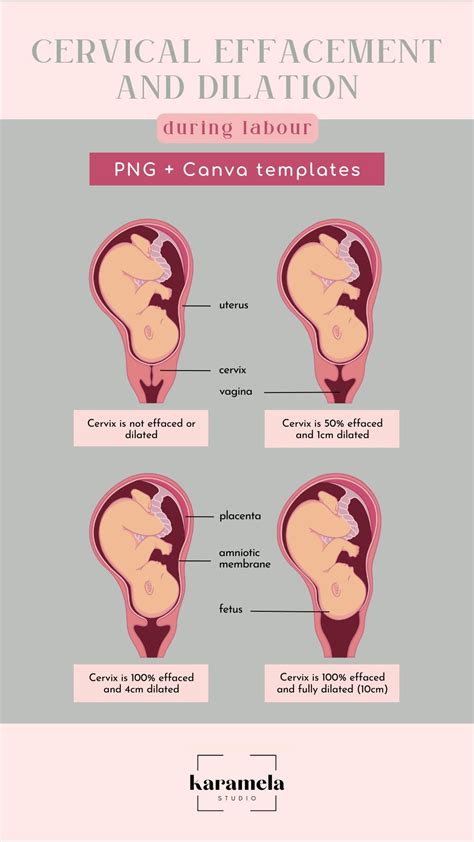 Printable Diagram Of Cervical Effacement And Dilation Birth Etsy