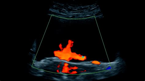 Abdomen And Pelvis Ultrasound The Ultrasound Suite