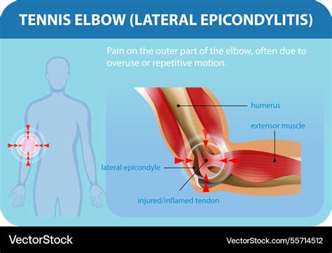 Tennis Elbow Anatomy And Symptoms Royalty Free Vector Image