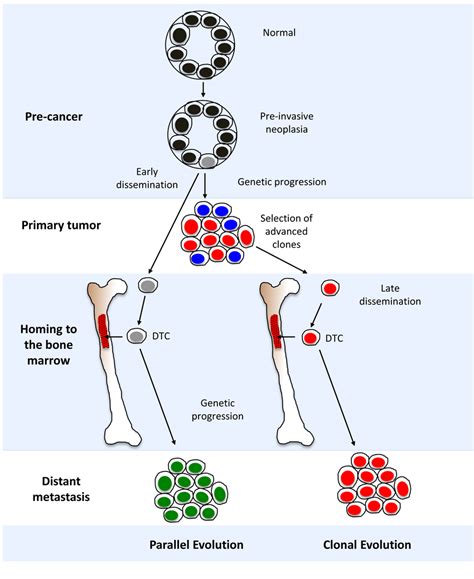 Tumor Progression Schematic Representation Of Tumor Development With