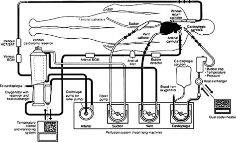 1 Typical Confi Guration Of A Basic Cardiopulmonary Bypass Circuit