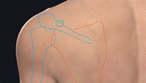 Scapular Winging Sport Med School