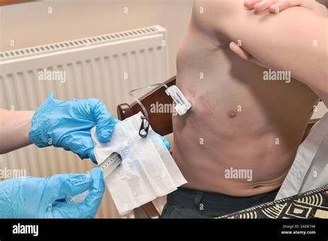 MODEL RELEASED Intravenous Drug Administration Via An Implanted Venous Access Port Portacath