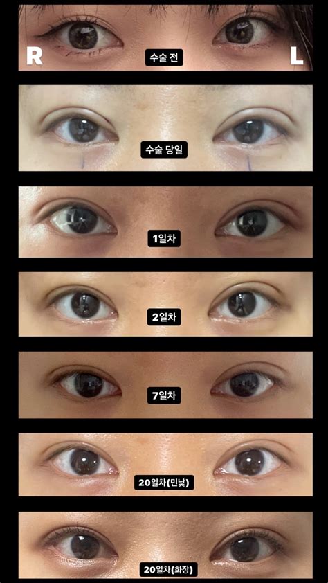 대구 리프트성형외과 강남언니