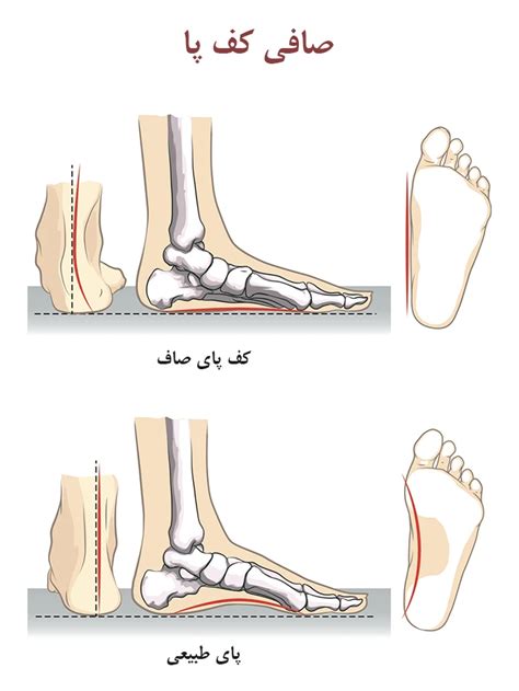 صافی کف پا علل بروز، نشانه ها، روش تشخیص و درمان