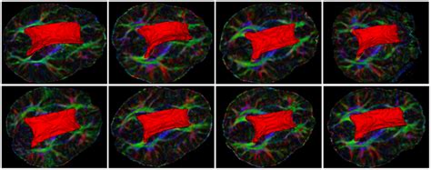 surfaces of the corpus callosum segmentation results from another 8