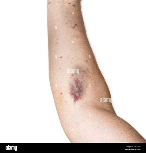 Subcutaneous Hematoma Due To Poor Blood Extraction Concept Malpractice