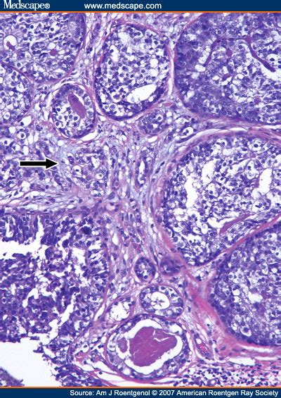 Story Ore Blog Lumpectomy Mastectomy