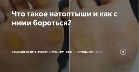 Что такое натоптыши и как с ними бороться? | Подолог в Симферополе ...