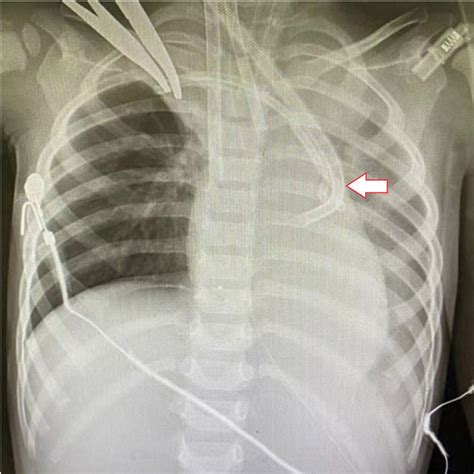 Chest X Ray Indicated Venous Cannula Was Inserted Into Left Atrium