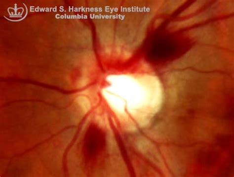 Splinter Optic Disc Hemorrhage Vagelos College Of Physicians And Surgeons