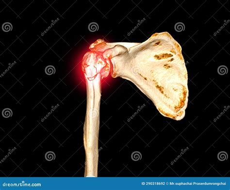 Ct Scan 3d Rendering Of Shoulder Joint Showing Fracture Head Of Humerus Stock Illustration