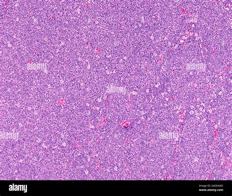 Diffuse Large B Cell Lymphoma Light Micrograph Diffuse Large B Cell Lymphoma Is The Most