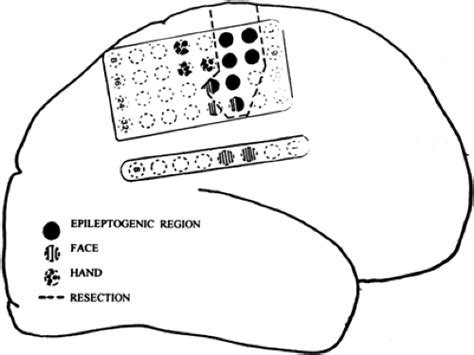 Extraoperative Functional Mapping Neupsy Key