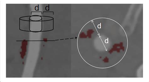 Example Of Pvat Phenotyping Around The Carotid Artery Perivascular
