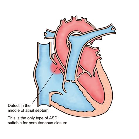 Atrial Septal Defect Asd Leeds Teaching Hospitals Nhs Trust