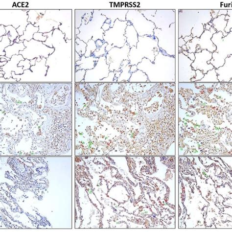 Ace2 Tmprss2 And Furin Expression In Alveolar Type Ii Pneumocytes And