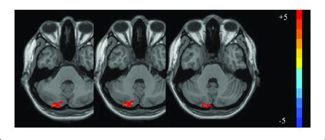The Significantly Altered Amplitude Of Low Frequency Fluctuation Download Scientific Diagram