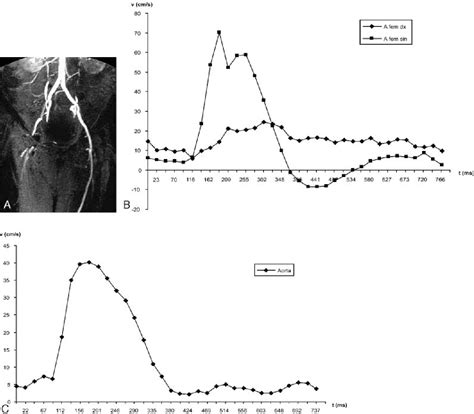 Figure 2 From Correlation Of Femoral Artery Flow Velocity Waveform With