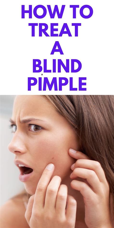 How To Get Rid Of Blind Pimples Artofit