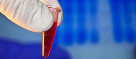 Test Details Engraftment Chimerism Analysis For Allogeneic Hematopoietic Stem Cell