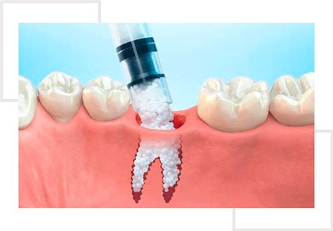 Bone Grafting Solutions By Topeka Oral Surgery Call Now