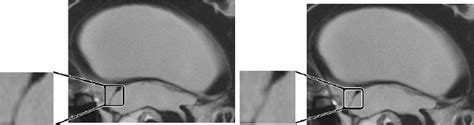 Two Images From A Brain Cine Mri Sequence A First Image Of The