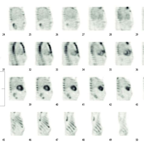 A M Technetium Pyrophosphate Single Photon Emission Computerized Download Scientific Diagram