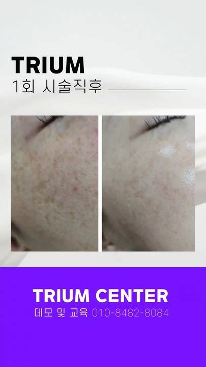 색소 모공 미백 탄력관리 트라이엄 시술 후기 트라이엄 트라이엄레이저 Youtube
