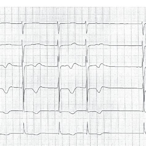 Pdf Amiodarone Induced Life Threatening Ventricular Arrhythmias In A Patient With