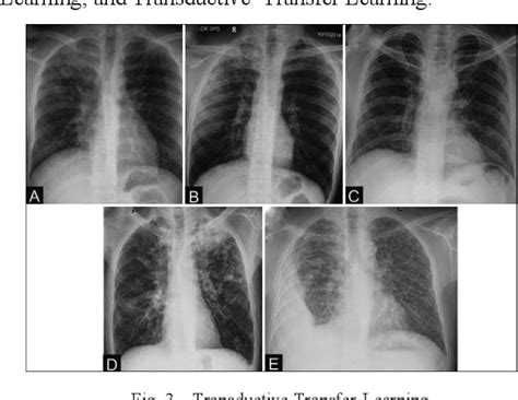 Figure 3 From Detection And Classification Of Tuberculosis Hiv Positive Patients Using Deep