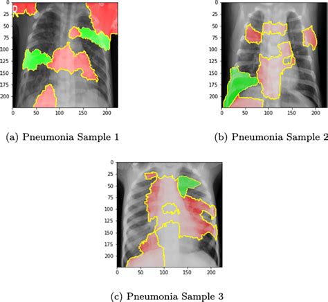 Pneumonia Images Output From Lime Download Scientific Diagram
