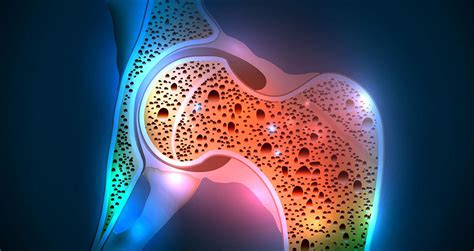Does Your Patient Have Low Bone Density Why To Utilize Dxa Scanning
