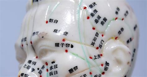 Acupuncture Achieving De Qi Improves Facial Muscle Recovery In Patients With Bells Palsy